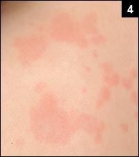 A 7-month-old girl with a febrile illness, rash