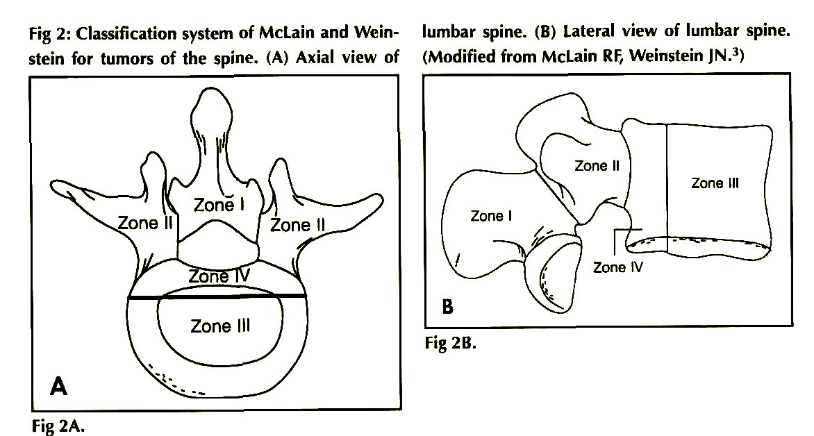 METASTATIC DISEASE OF THE SPINE