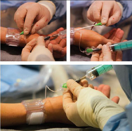 Radial Access in Practice